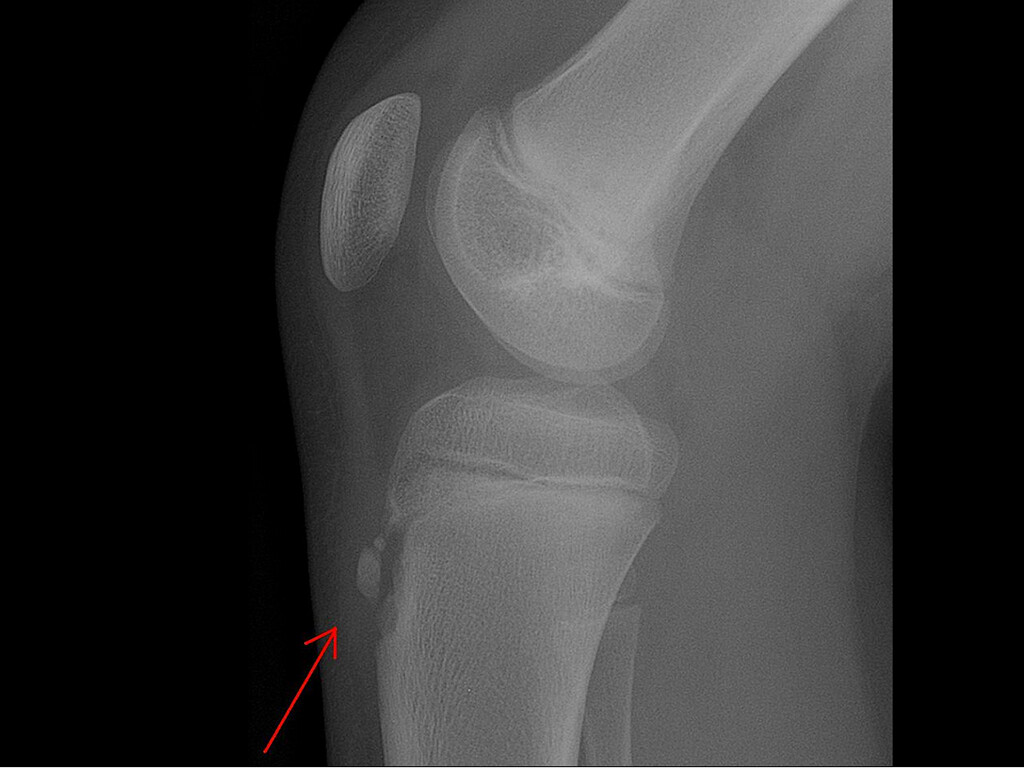 Morbus Osgood-Schlatter häufig bei sehr sportlichen Kindern - MedMix