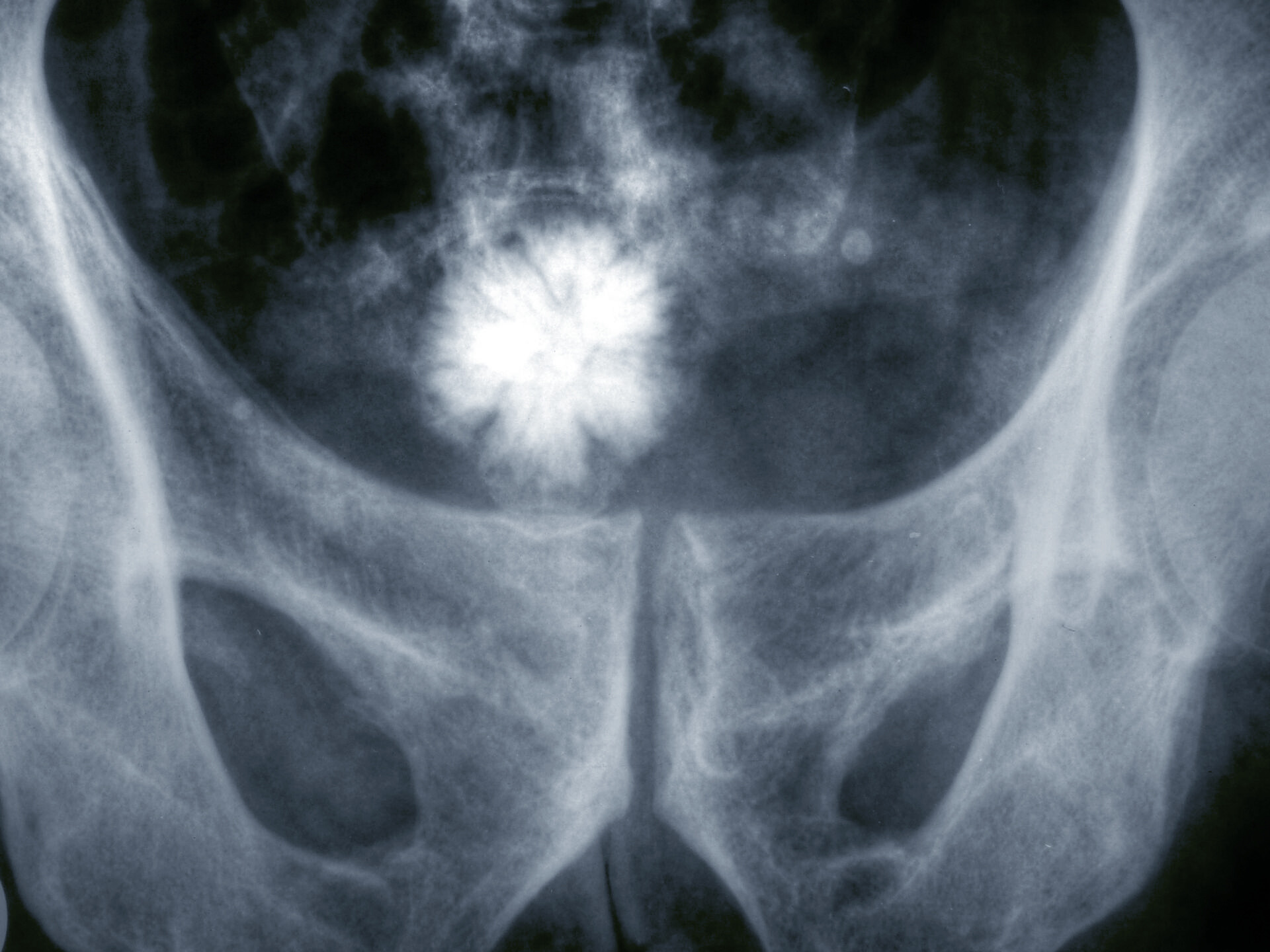 harnsteine_wikimedia - MedMix