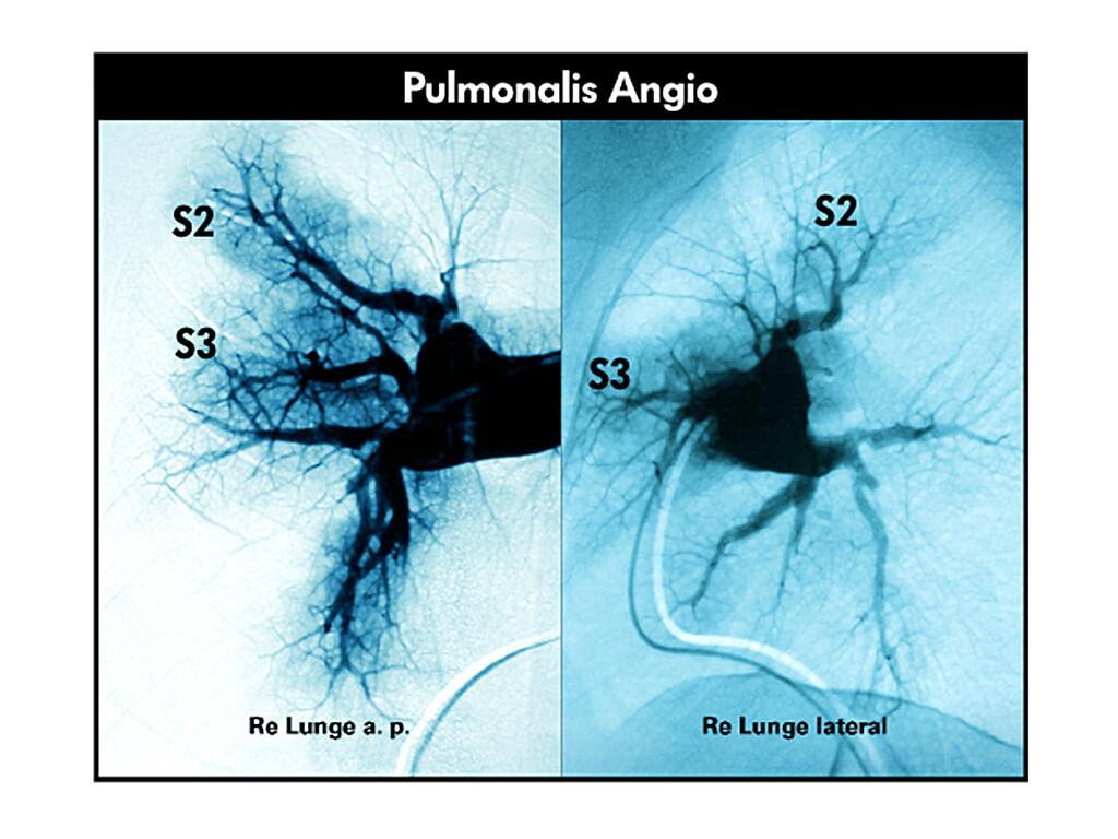 Pulmonale Hypertonie – Klassifikation und Pathophysiologie