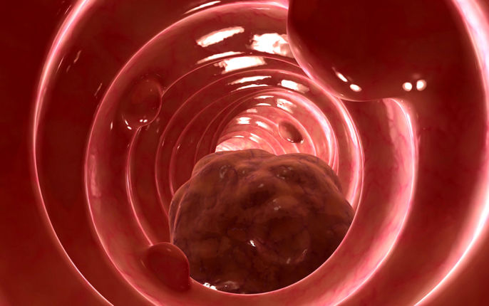 CME: Neue minimal-invasive Operation beim Kolonkarzinom