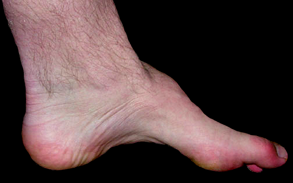 Charcot-Marie-Tooth – hereditäre Neuropathie - MedMix