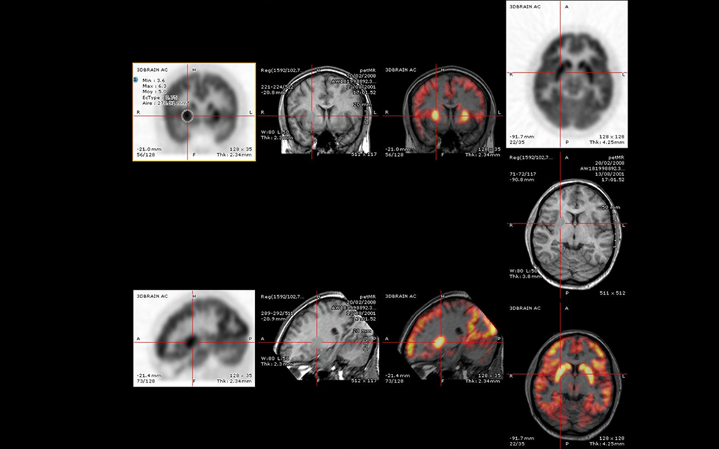 Neuroimaging und Molekulare Diagnostik in der Neuroonkologie - MedMix