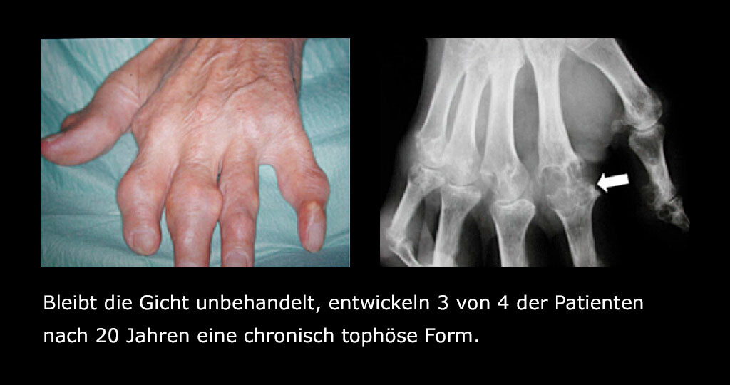 Harnsäurespiegel bei Gicht-Arthritis senken wichtigstes Therapieziel