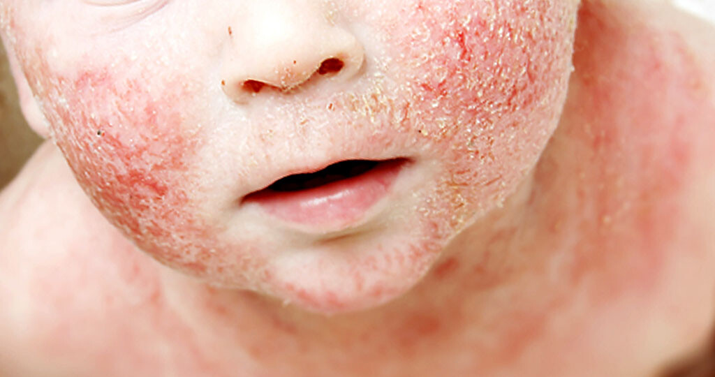 Neurodermitis: Vitamin E, Vitamin D, Probiotika sowie Fettsäuren